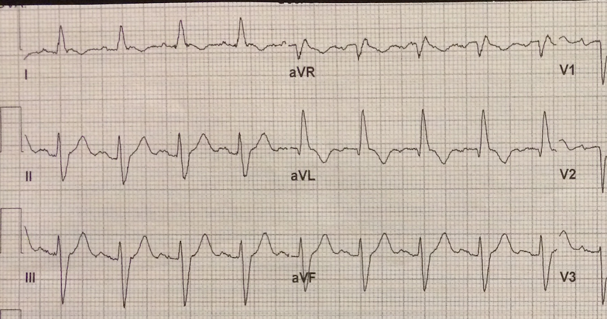 Dr. Smith's ECG Blog: Prolonged chest pain and Intraventricular ...