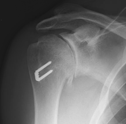 UW Shoulder and Elbow Academy: A 40 year old athlete with ...