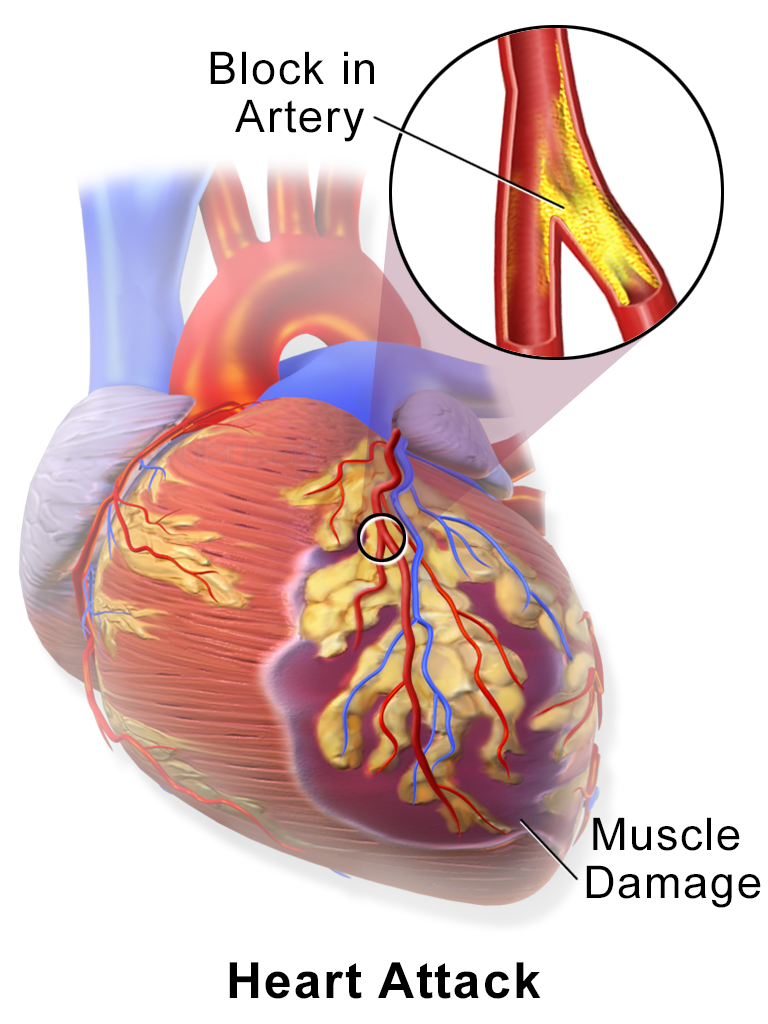 Acute Coronary Syndrome | Blog Kardio Indonesia