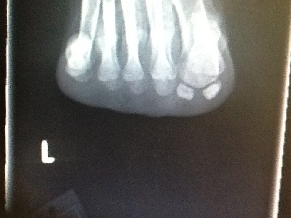 Foot and Ankle Problems By Dr. Richard Blake: Sesamoid Injury Reflare ...