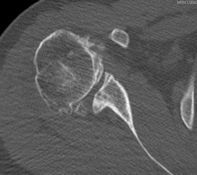 Shoulder Arthritis / Joint Replacement : Does a preoperative CT show ...