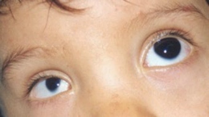 Teratodonto: Microftalmia