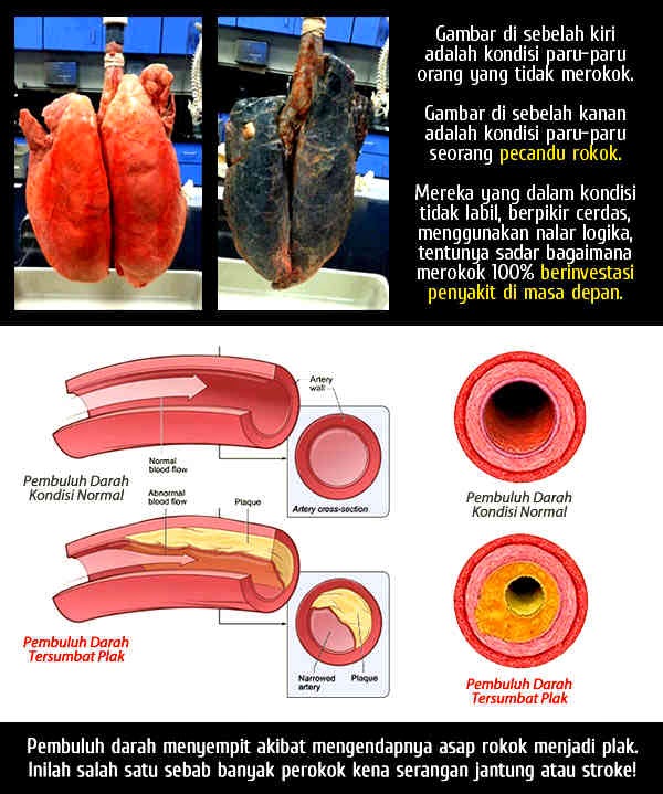 Bisa Berhenti Merokok Itu... - Blog ZN