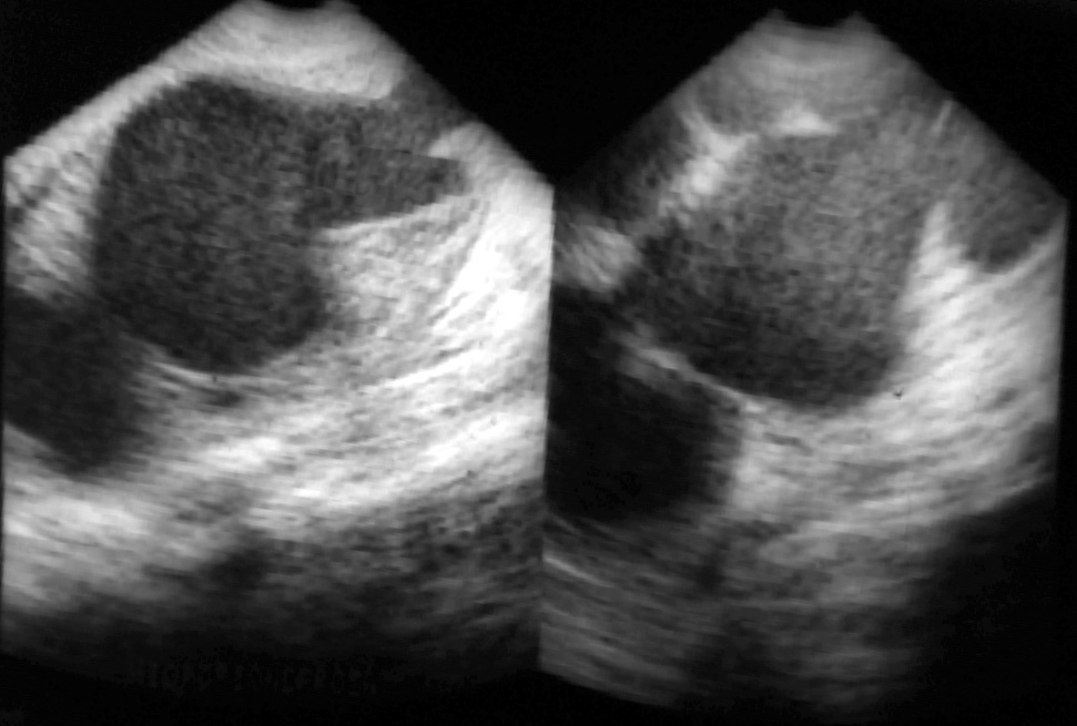 ecografie imagini medicina renal Renal nativ Hidronefroza | Terapii ...