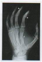 Jejak Radiologi: TEKNIK PEMERIKSAAN OSSA MANUS