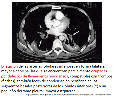 ESPE 202 - 2014: Caso clínico: TEP
