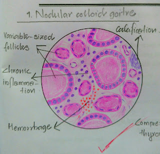 Histopathology Drawings: Nodular colloid goitre