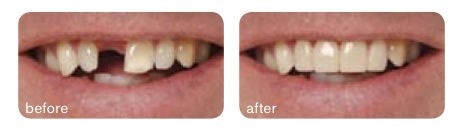 Crystal Lake Dental's Hot topics: Temproary partial denture Crystal ...