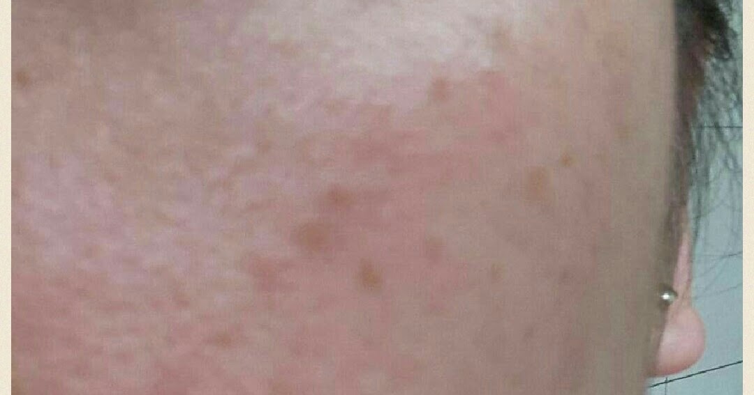 Best Blend For Sensitive Skin Since 2009: Dark Spot Fading Testimonial Pic