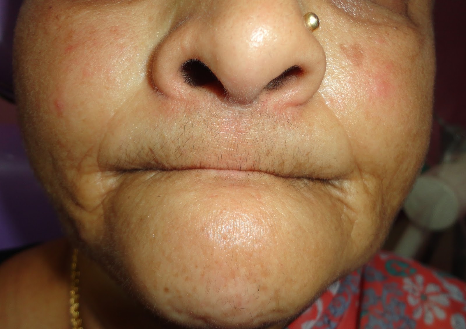 IHDE Dental Implants: Missing teeth, unable to chew, bad facial ...