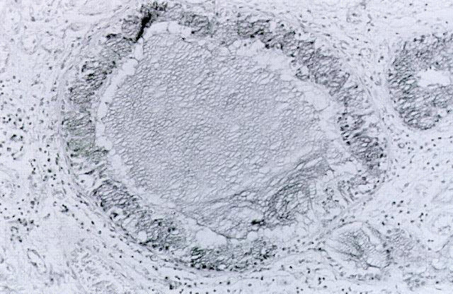 Taysir assistance الإسعاف الطبي تيسير: Bronchiole dilatée avec ...