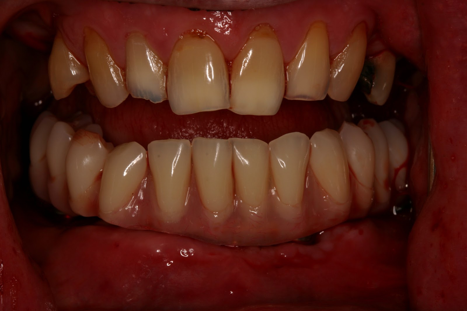 Dr. Robert G. Tupac: Prosthodontics: Lower Teeth In A Day