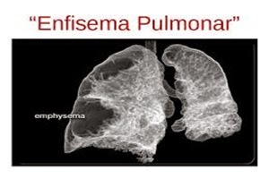 Trata-se de uma doença crônica, na qual os tecidos dos pulmões são ...