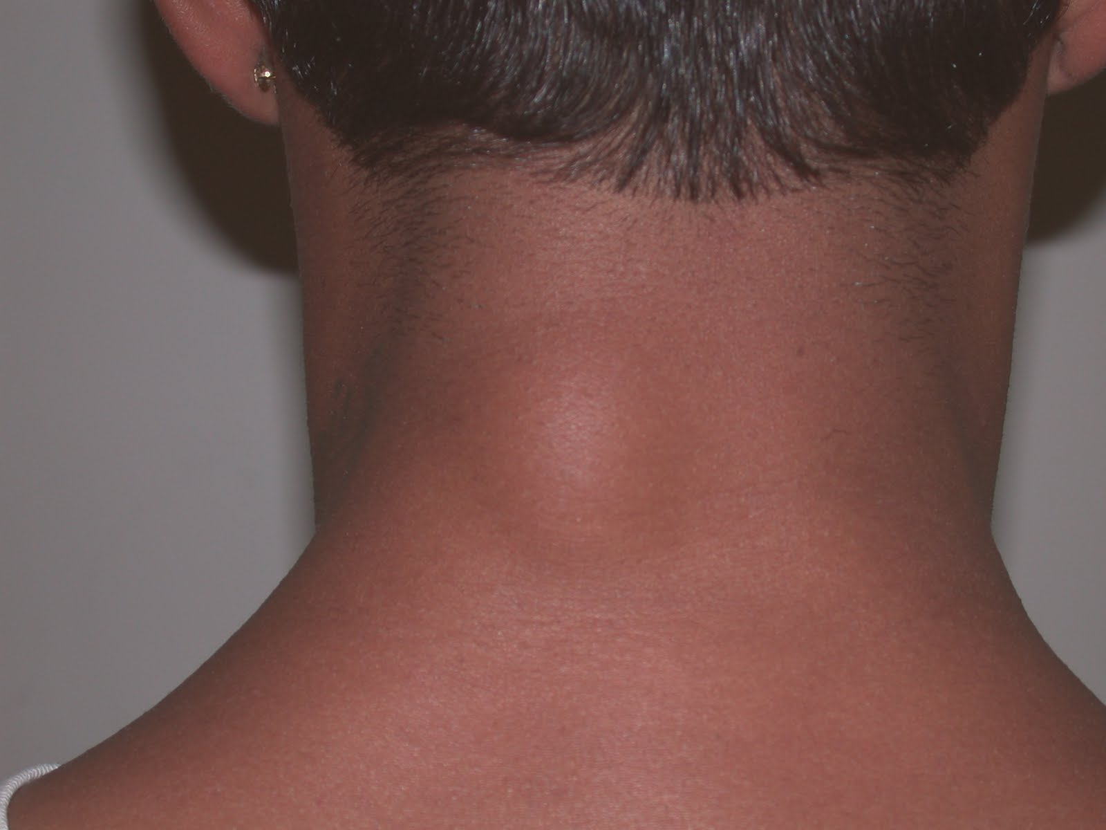 TEMAS DE INTERES EN MEDICINA DESCRIPCI N DE UN LIPOMA temas-de-interes-en-medicina-descripci-n-de-un-lipoma