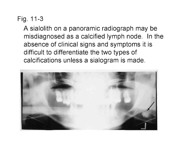 Dentistry and Medicine: SOFT TISSUE CALCIFICATIONS IN ORO-MAXILLO ...