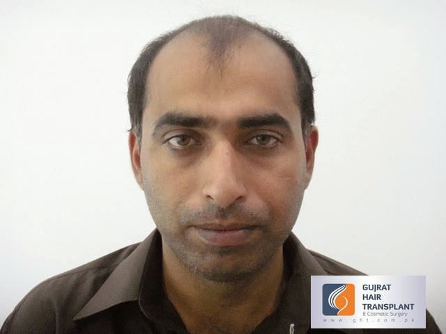 Hair Transplant Surgery In Pakistan With Most Natural Results