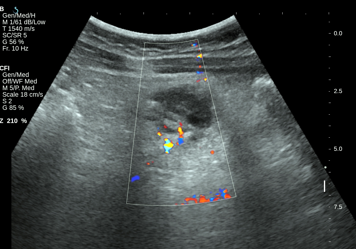 VIETNAMESE MEDIC ULTRASOUND: CASE 389: ECTOPIC APPENDICITIS, Dr PHAN ...