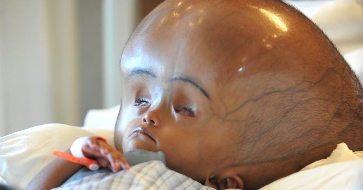 Doctors Shrink Head of Baby with Swollen Skull ~ Entertainment News ...