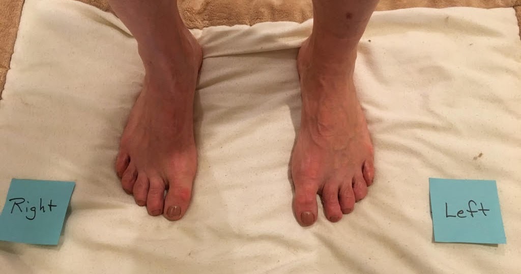 Foot and Ankle Problems By Dr. Richard Blake: Hallux Varus after ...