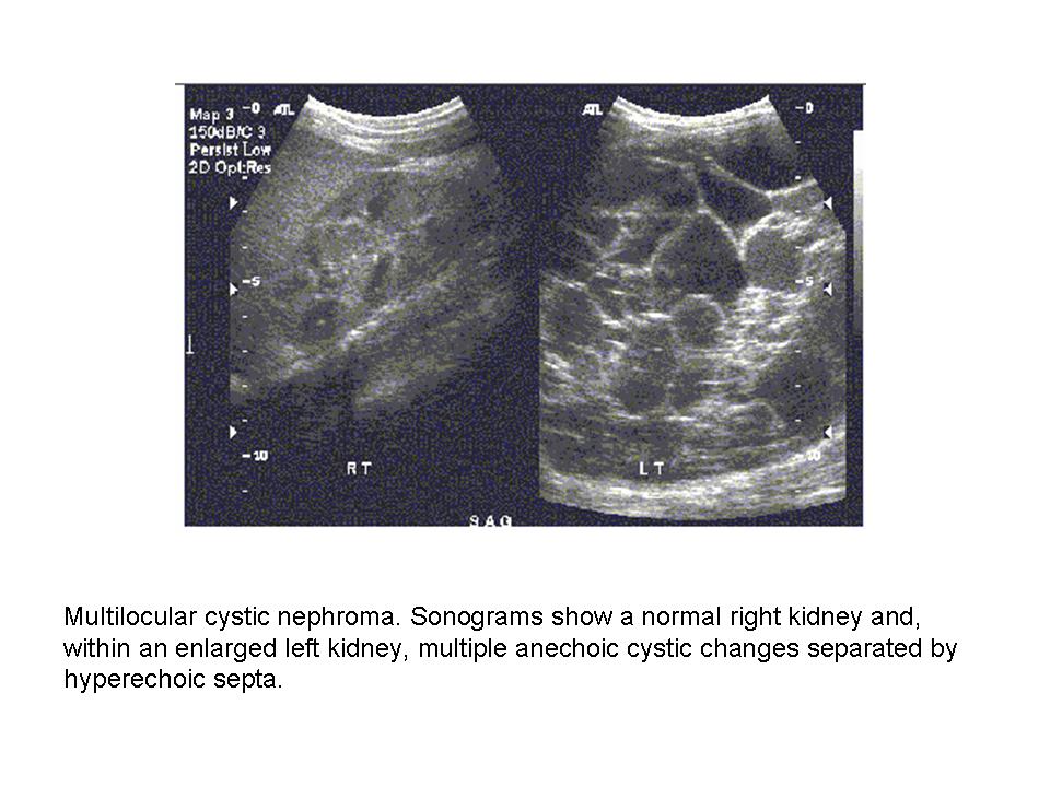 BÀI SOẠN VỀ SIÊU ÂM CHẨN ĐOÁN: NHÂN CA MULTILOCULAR CYSTIC RCC tại MEDIC