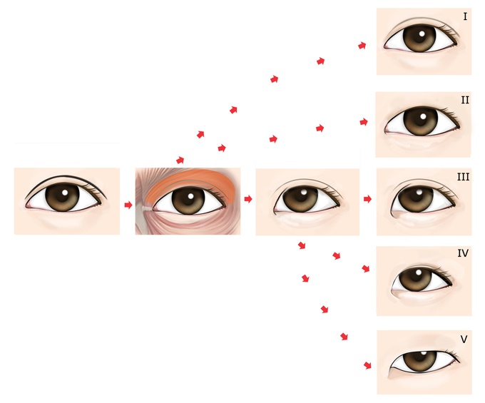 Teuim Aesthetic Plastic Surgical Clinic Dr.Kwon: What is the epicanthus?