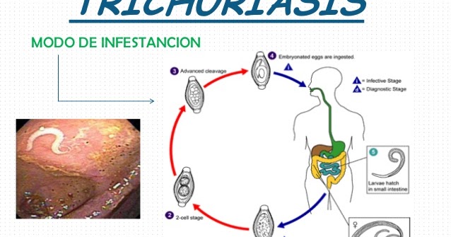 Enfermedades infecciosas: Enfermedades Tropicales( IV) Trichuriasis