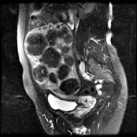 Dr. Gordon Lim's Gynaecology blog: Multiple fibroids- myomectomy vs ...