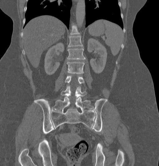 Ultimate Radiology : Castellvi Type IIIb LSTV