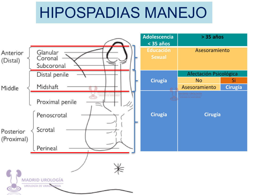 Madrid Urología: HIPOSPADIAS. Asesoramiento en adolescentes y adulto joven.