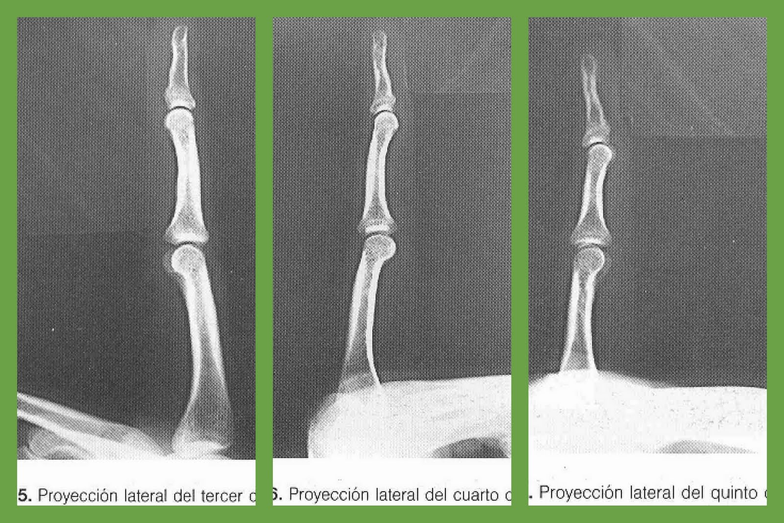 tecradiologos: DEDOS: SEGUNDO A QUINTO