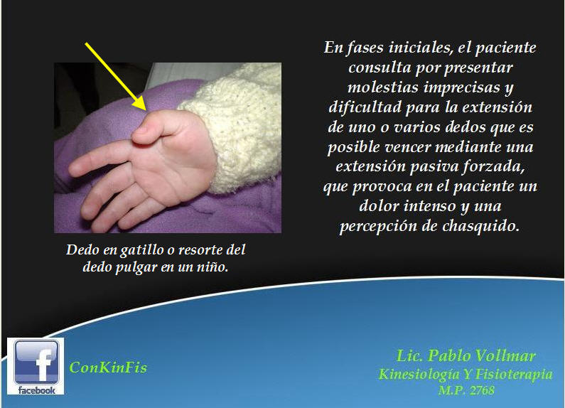 Consultorio Privado de Kinesiología y Fisioterapia: Dedos en Gatillo o ...