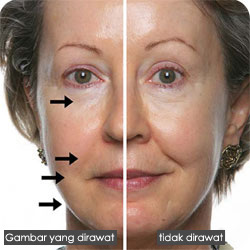 Setrika Wajah | Setrika Muka | Galvanic Spa: Setrika Wajah Galvanic Spa