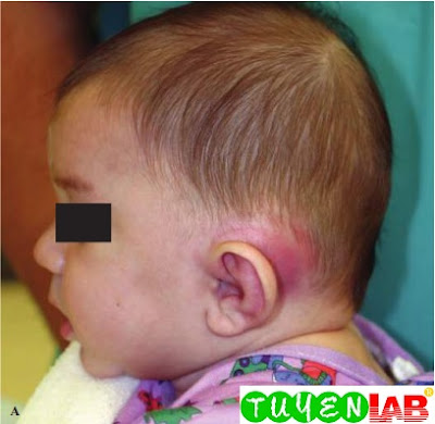 [Pediatric] Atlas of Otitis media - Acute otitis and otitis media with ...