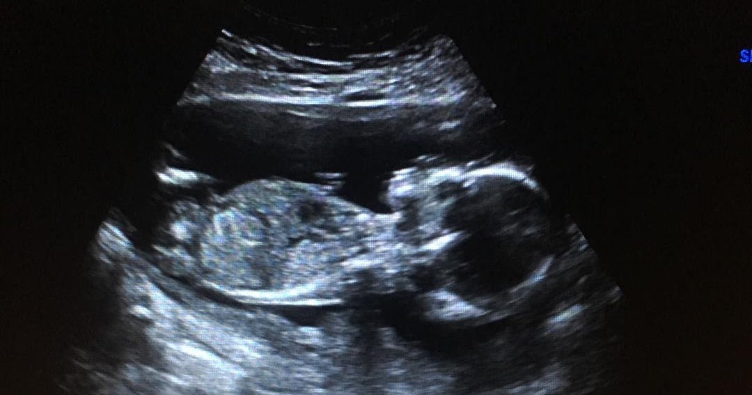 A little rain will fall: Our First Proper Baby Scan