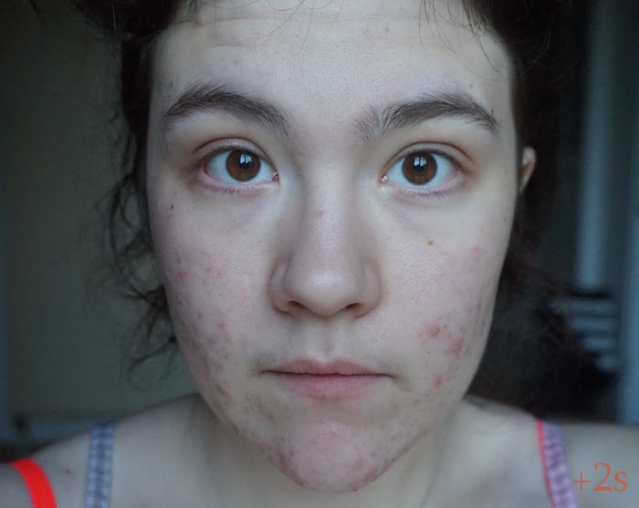 At War with Acne: Cicalfate & TriAcnéal Expert (Avène) won ! - Flavour ...