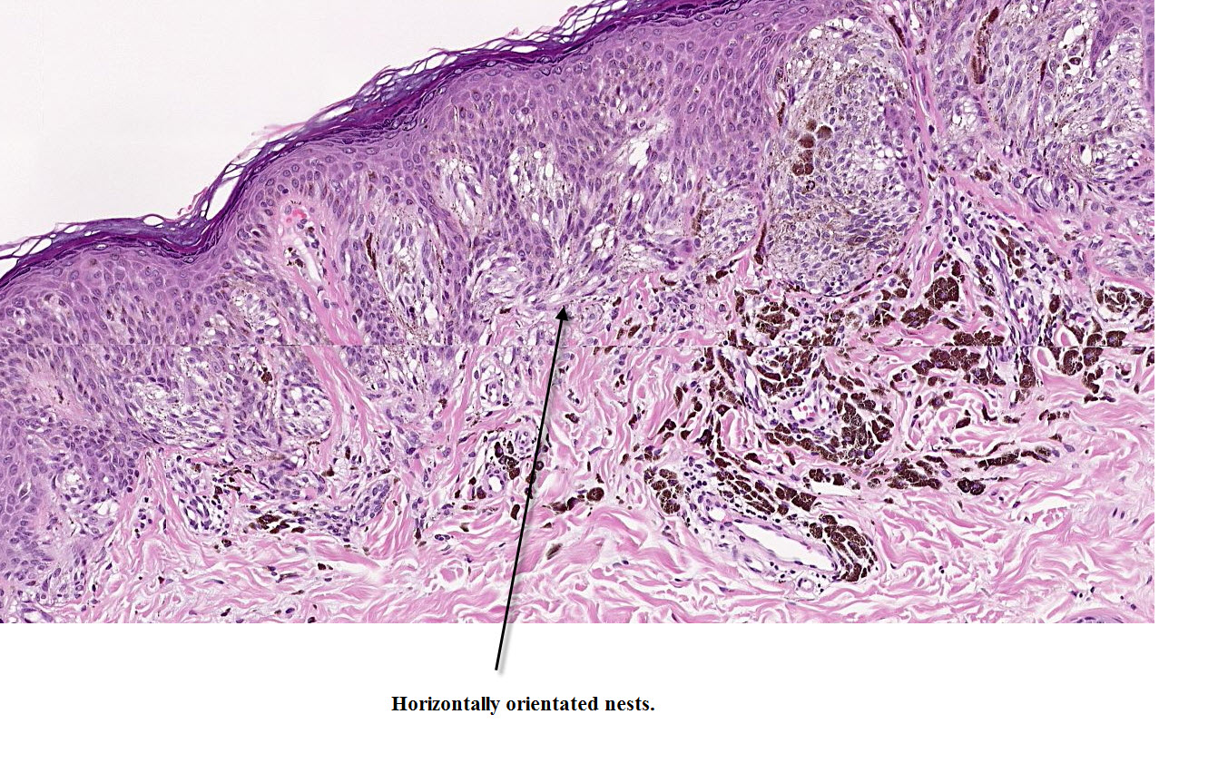 Dermpath Made Simple - Neoplastic: Spitz Nevus and Reed Nevus