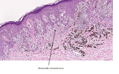 Dermpath Made Simple - Neoplastic: Spitz Nevus and Reed Nevus