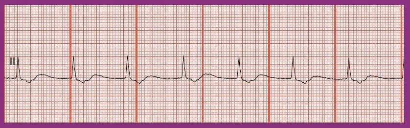 Practice EKG Rhythm Strips 228