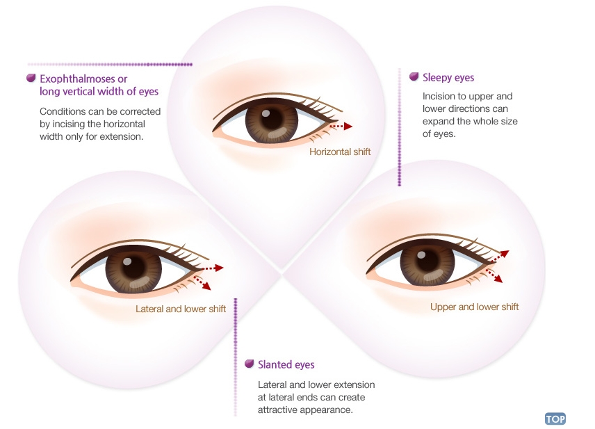 Eyelid Surgery Legend Dr. Kim Byung Gun: Eyelid Surgery:Outer Corner ...