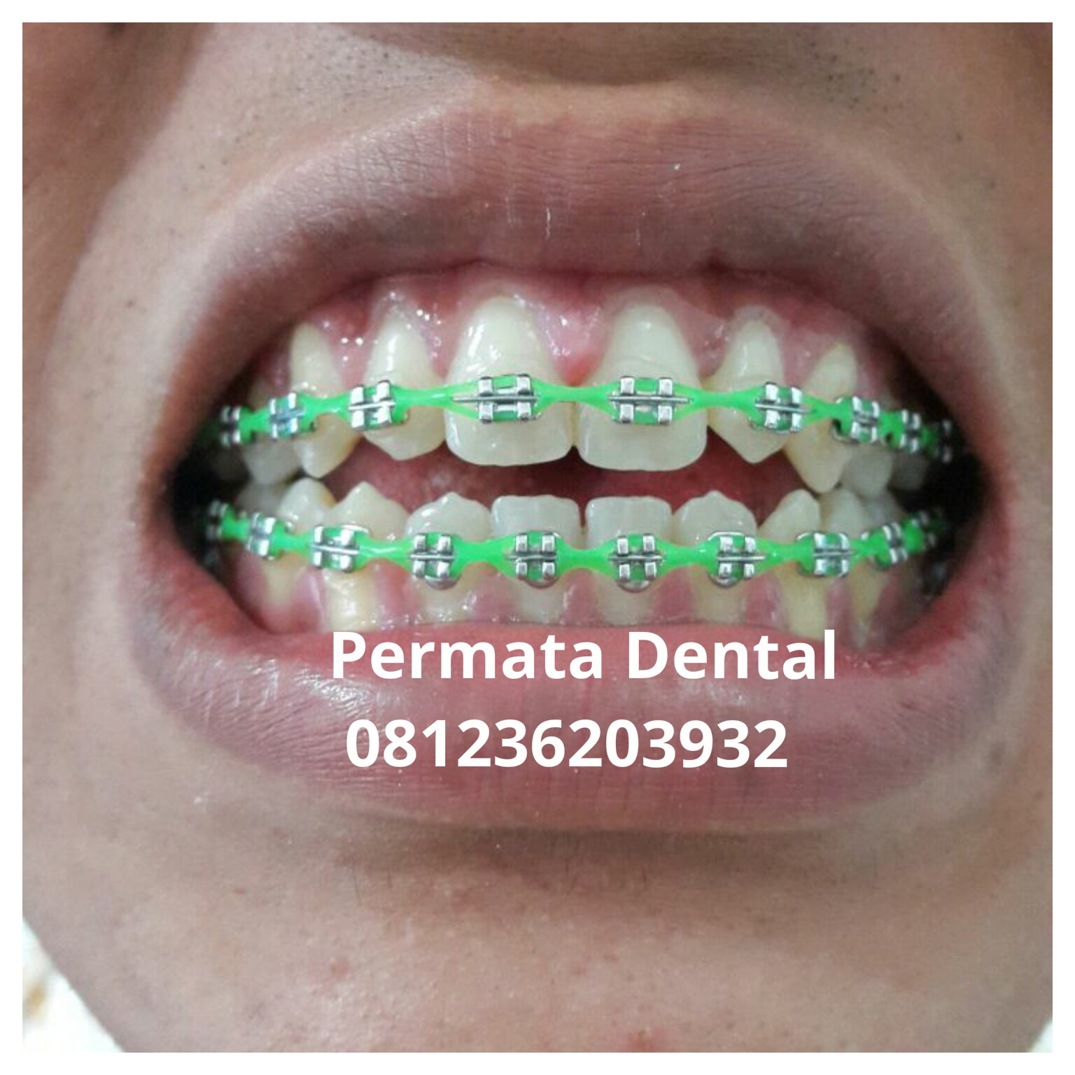 DOKTER GIGI BALI: Behel | Barcket | Kawat Gigi Perawatan