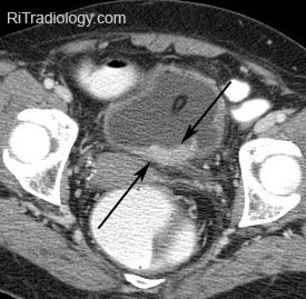RiT radiology: Focal Urinary Bladder Wall Thickening