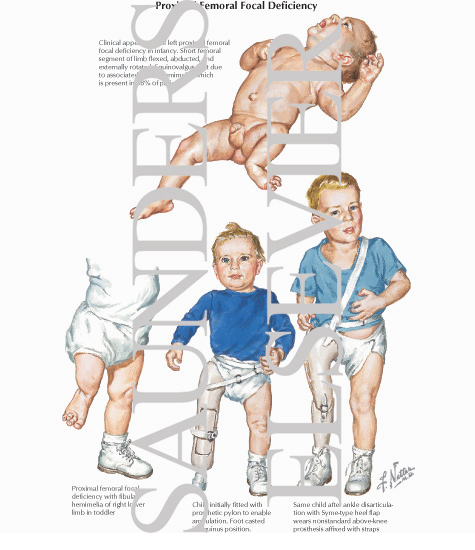 Proximal Femoral deficiency ~ Anatomy for MSP