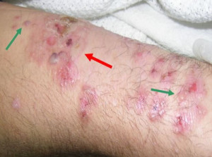 ASK DIS: Maculopapular Rash : Diagnosis