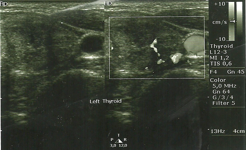 BEDAH UMUM FKUI: Prosedur MIVAT pada penatalaksanaan Nodul Tiroid