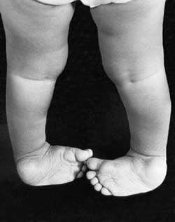 Vie Clínica de Fisioterapia: Artrogripose Múltipla Congênita