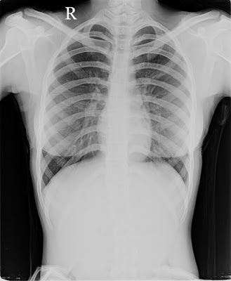 diagnostic radiology imaging: Chest X-ray Techniques and anatomy