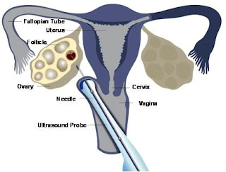 IVF ... IUI ... ICSI ... ART ...: My Egg Retrieval process at Manipa ...