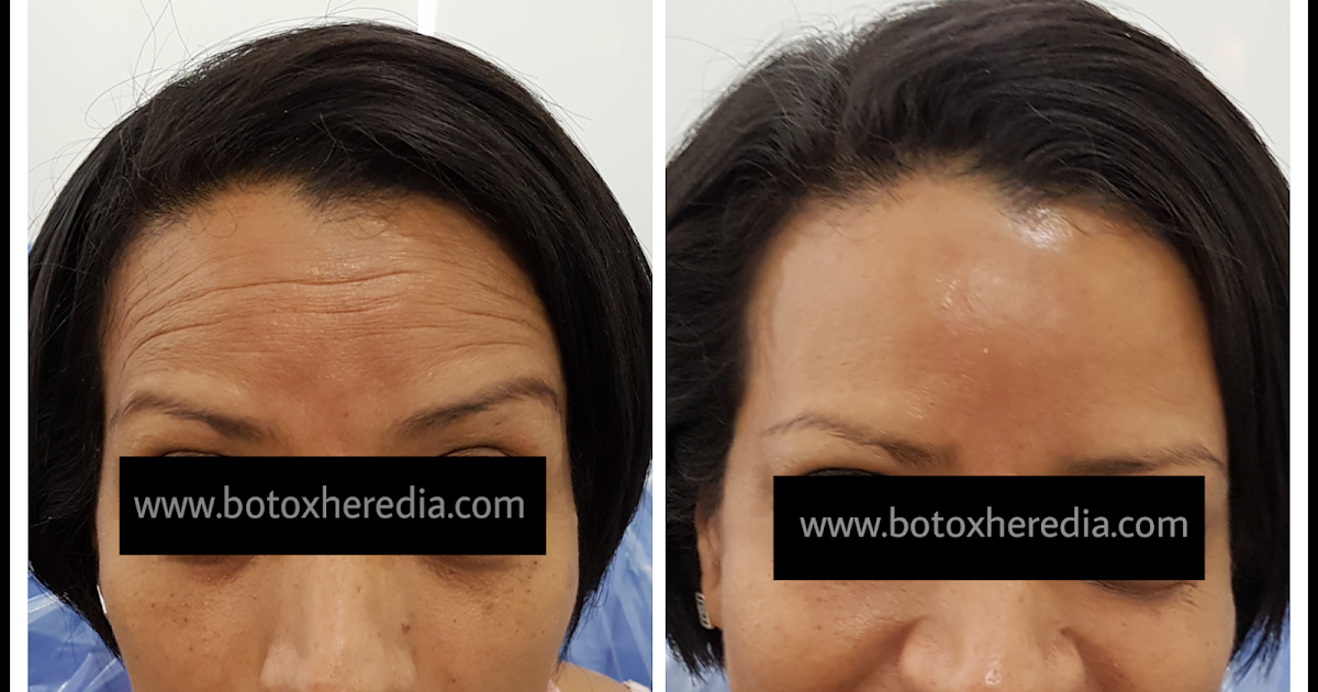 Botox, Acido Hialurónico, Bichectomia, Invisible Touch Hilos Pdo: