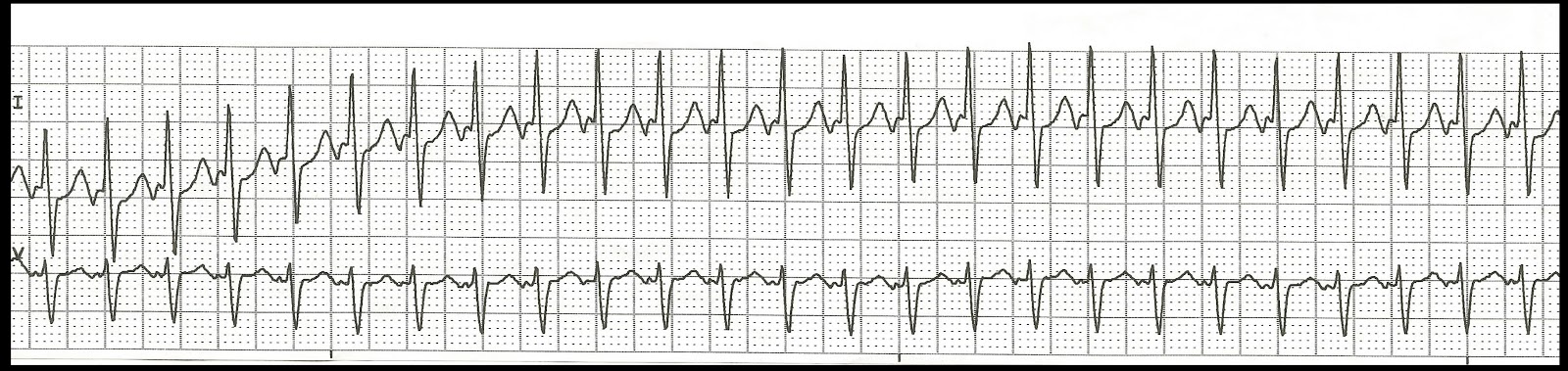 Practice EKG Rhythm Strips 168