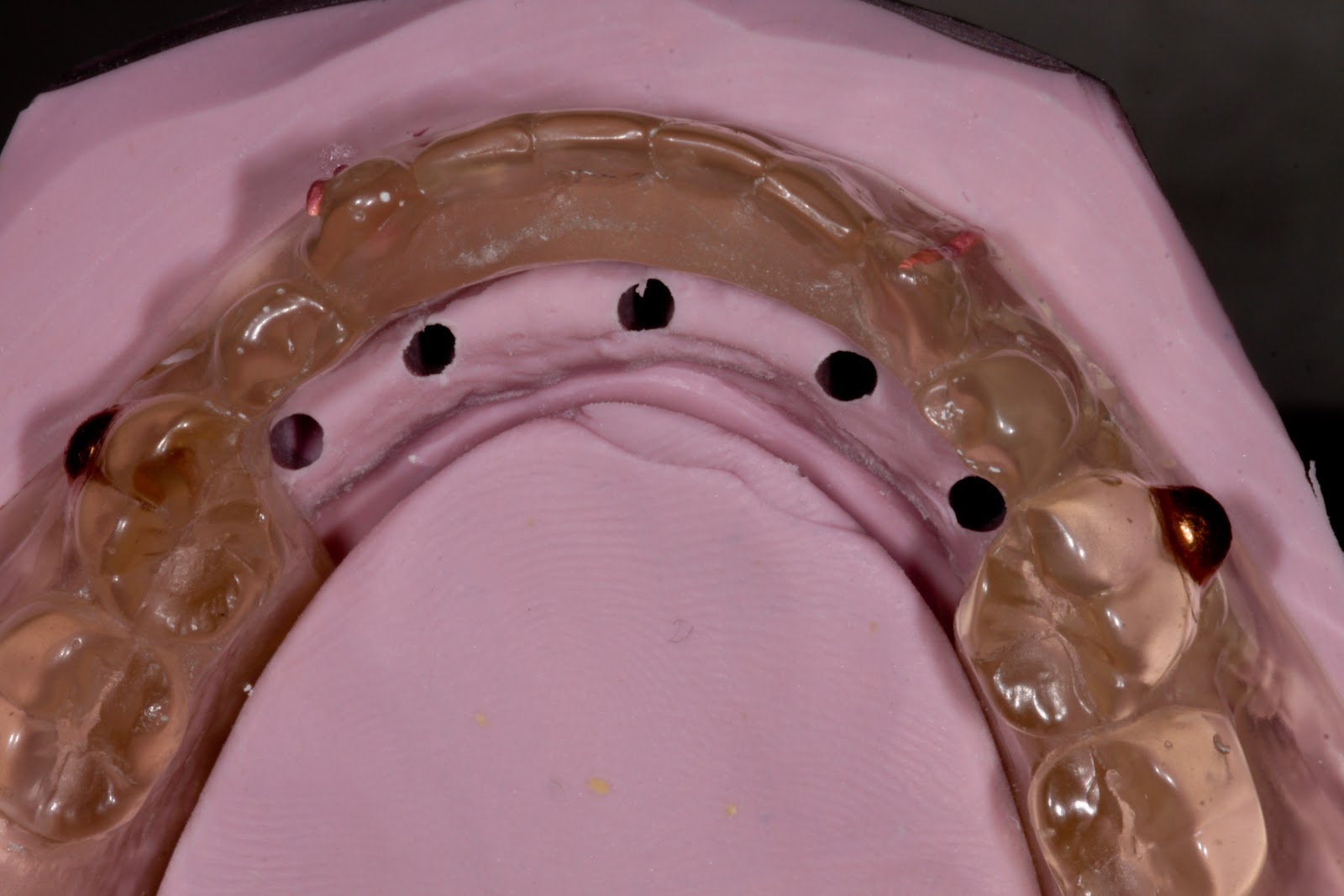 Boise Idaho Prosthodontics: Maxillary Complete Denture and Mandibular ...